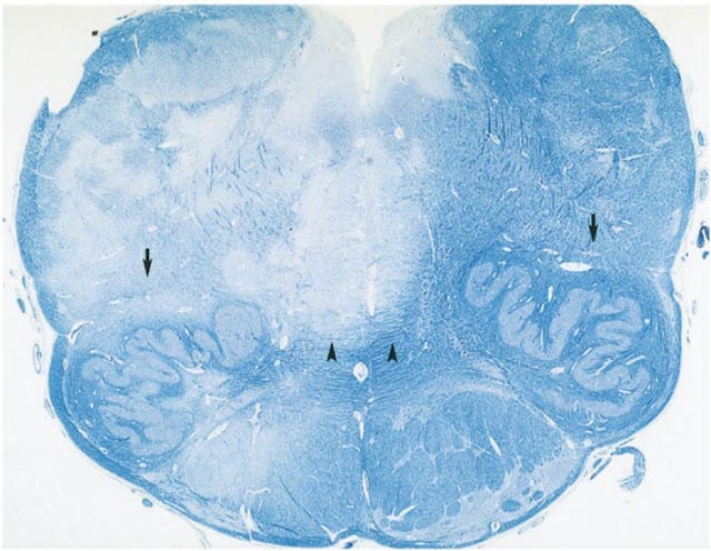 Sudden death in MS is very very rare - by Gavin Giovannoni