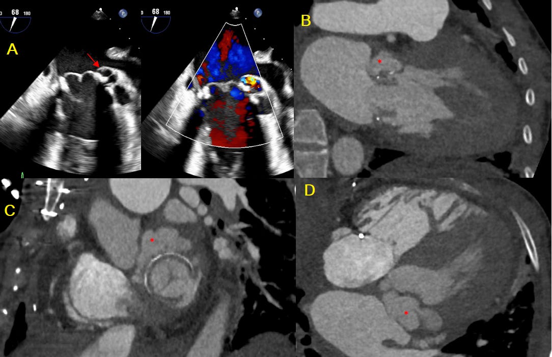 O diagnóstico da Endocardite Infecciosa