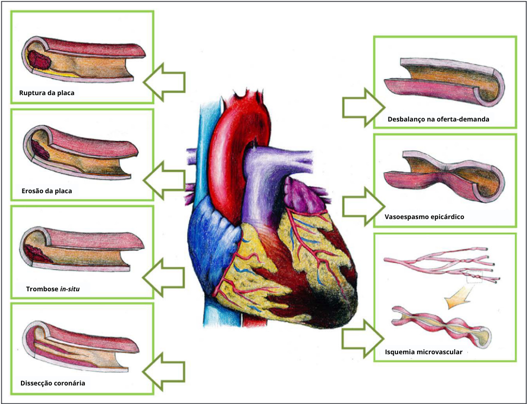 MINOCA, o que fazer?