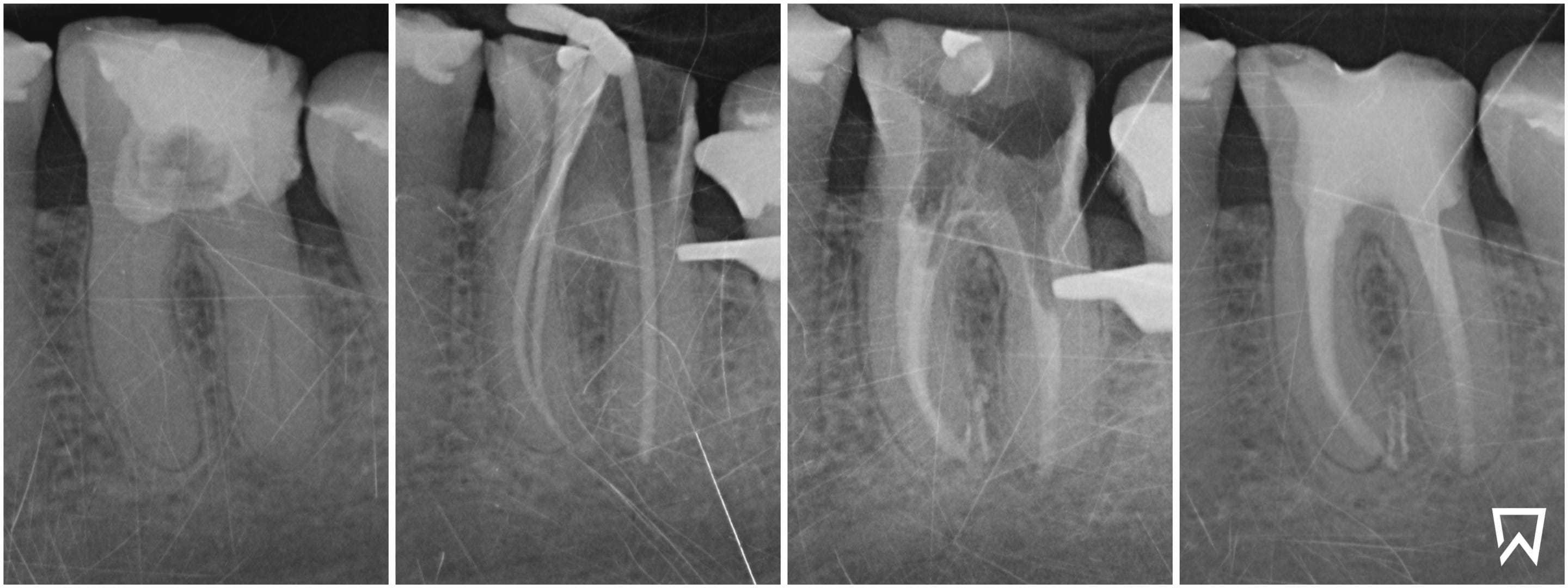#15 Deep margin elevation