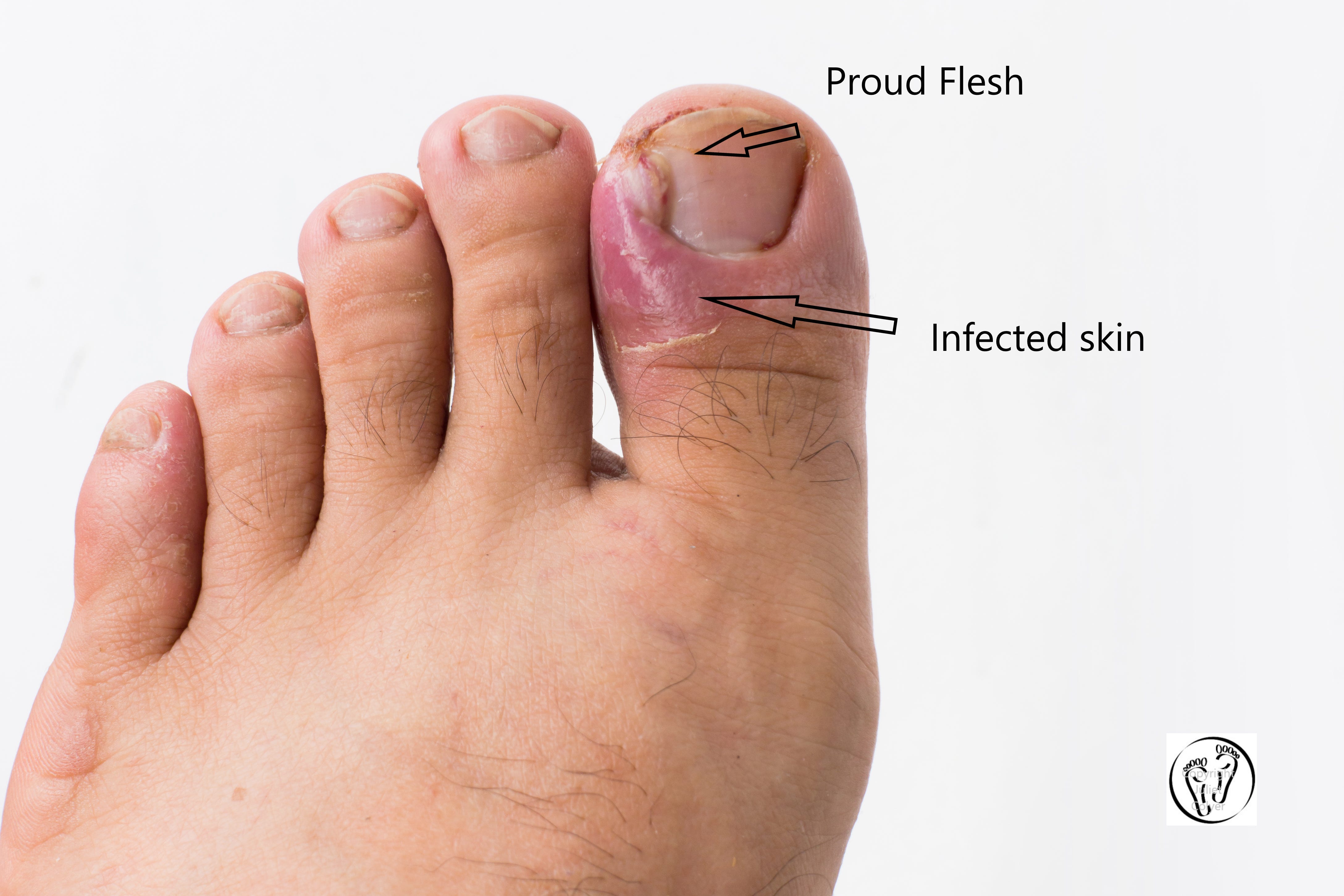 Ingrown Toenails - Practical Podiatry