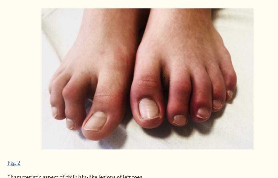 Cutaneous reactions to C-19 injections - by OUTRAGED HUMAN