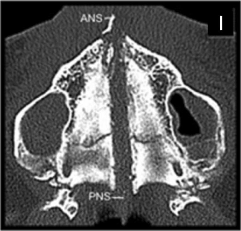 5.1 Intro to MARPE (MSE, FME, EASE, Custom MARPE)