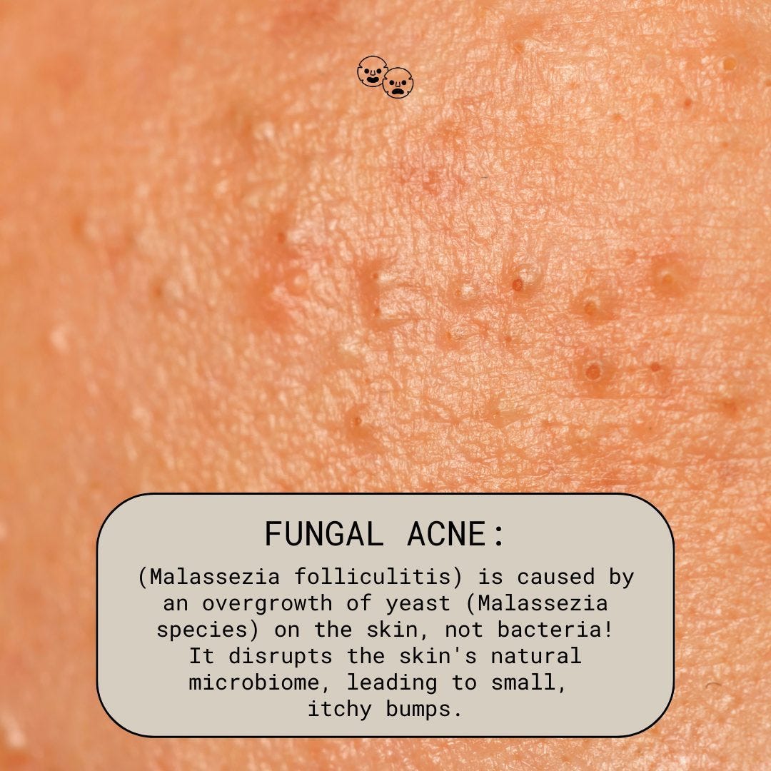 What is "fungal acne" anyway? - by sofie pavitt