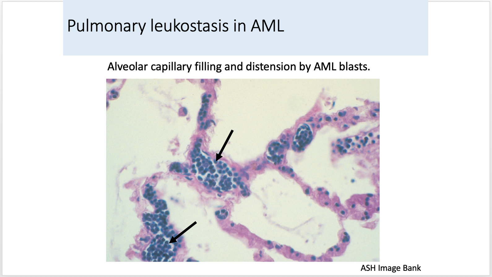 Leukostasis! - by Aaron Goodman "Papa Heme"