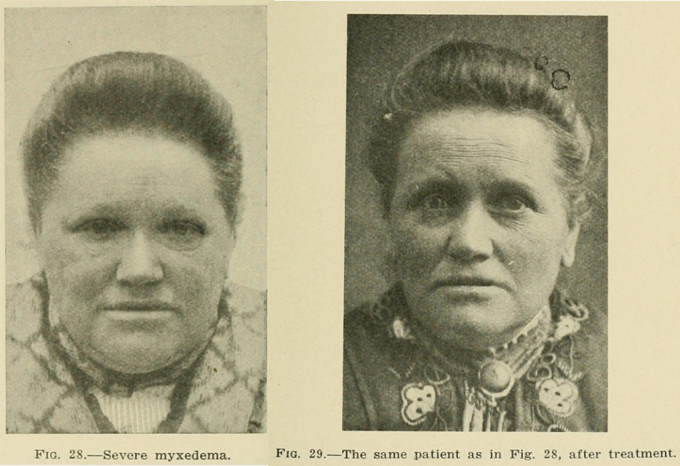 Thyroid Magic: Its History and 57 Examples