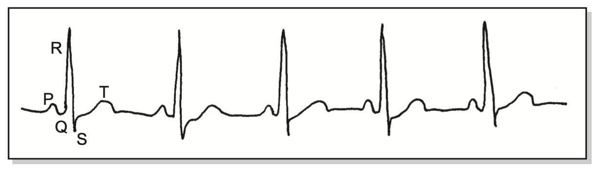A quite astonishing rise in the number of people diagnosed with atrial ...