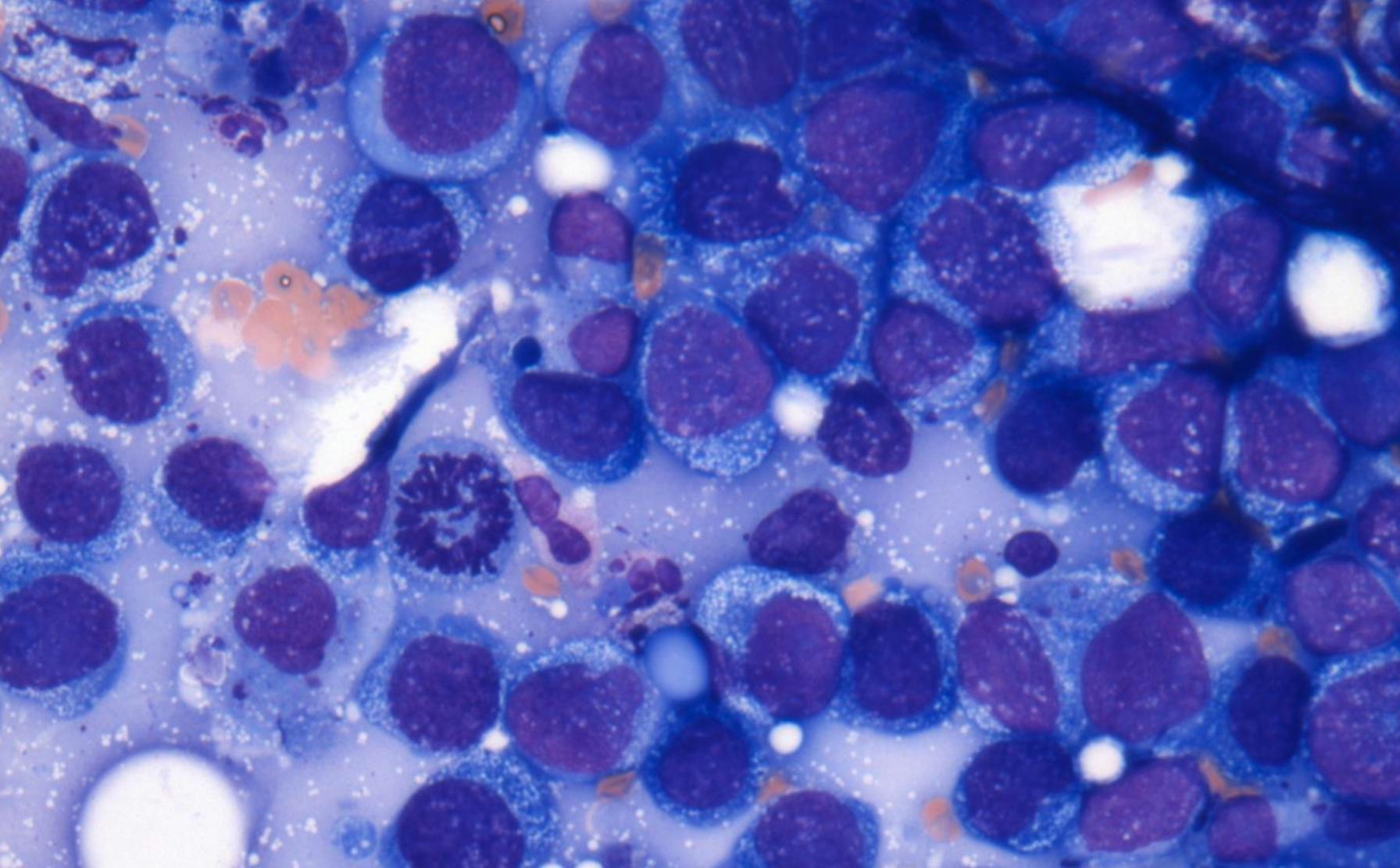 Understanding Advanced Lymphoma Diagnostics