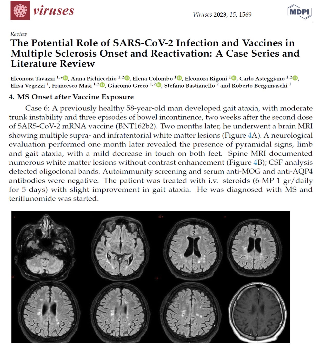 New-Onset and Flares of Multiple Sclerosis are Associated with SARS-CoV ...