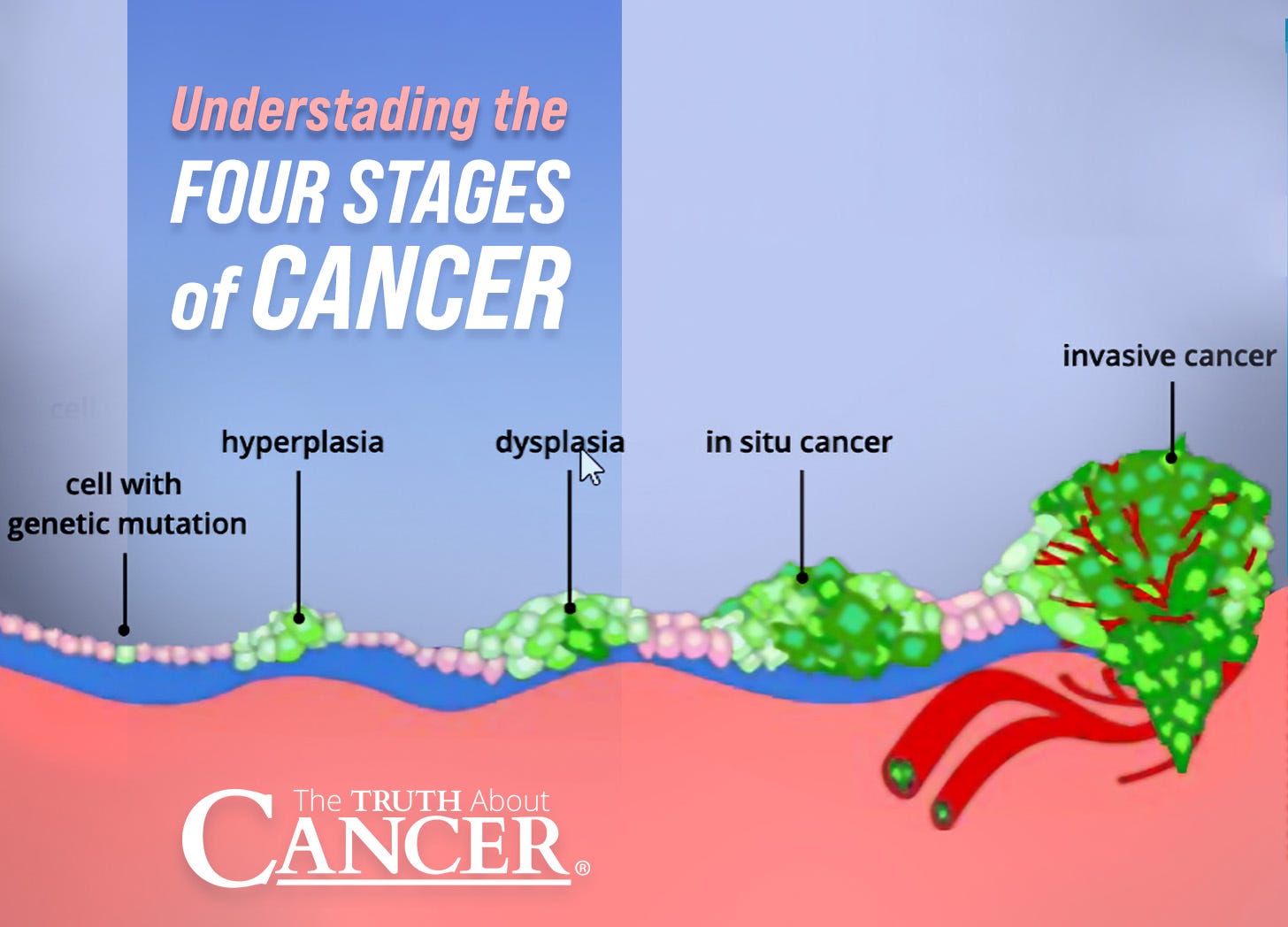 Understanding the 4 Stages of Cancer