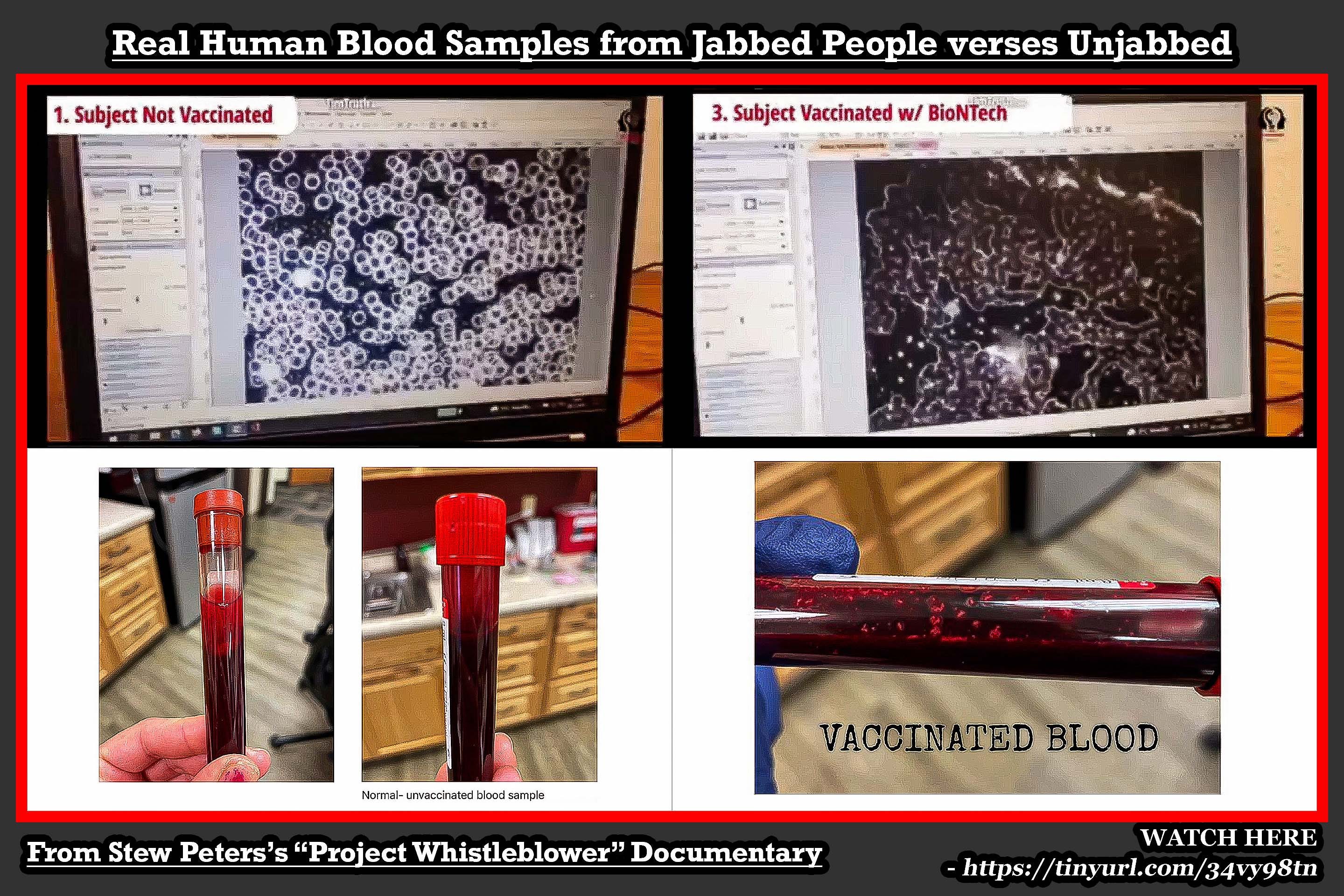 Real Human Blood Samples from Jabbed People verses Unjabbed