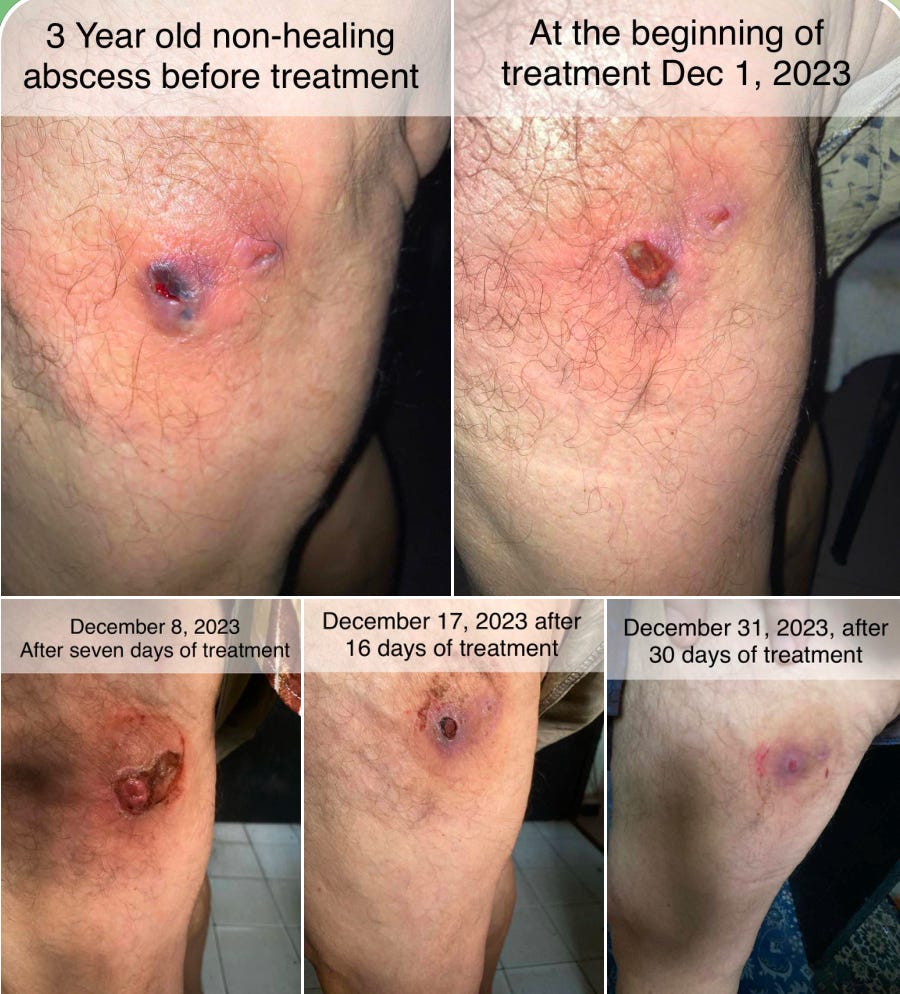 Eliminate Ear Infections, Remove Skin Cancers, Heal Spider Bites, and more