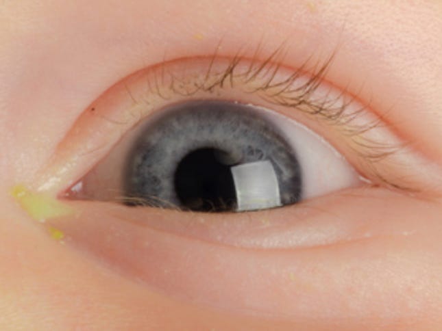 Pediatric Pearls: Infant's Eye Part 2 - Color, Discharge and Red Reflexes