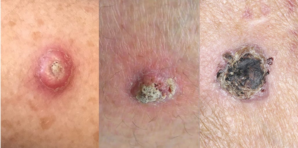Dermatology's Horrendous War Against The Sun
