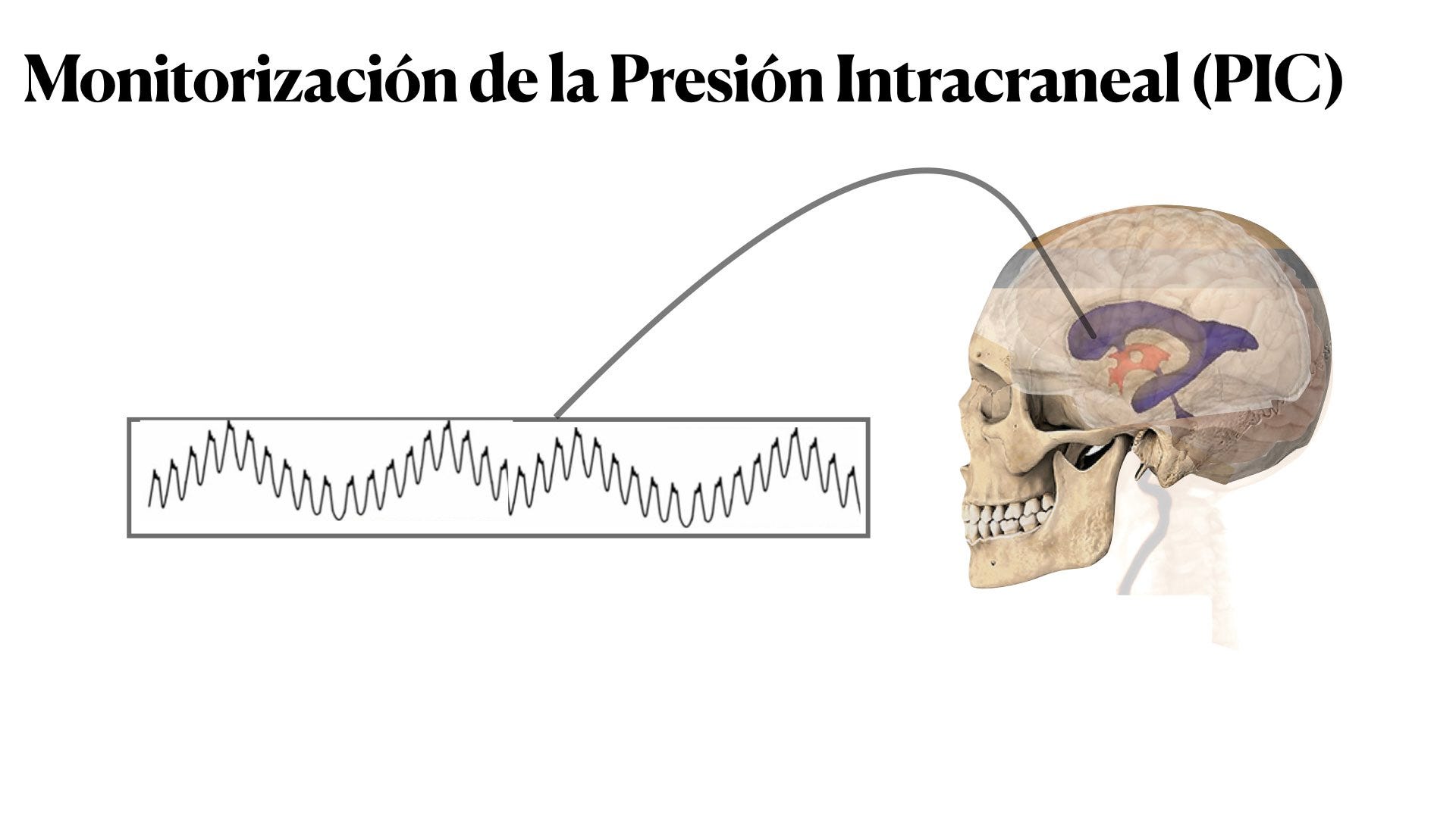 Hipertensión Intracraneal - by Nicolás Samprón
