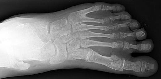 Henry Pious' sixth toe - Kurwamac’s Substack