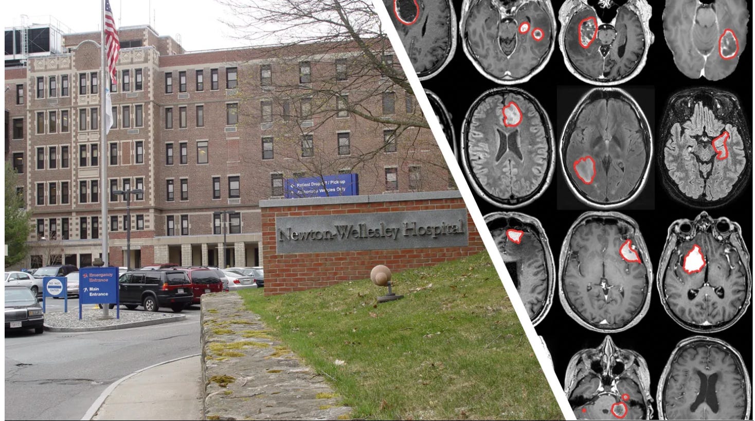 "Surge in brain tumours among nurses at Boston hospital triggers urgent ...