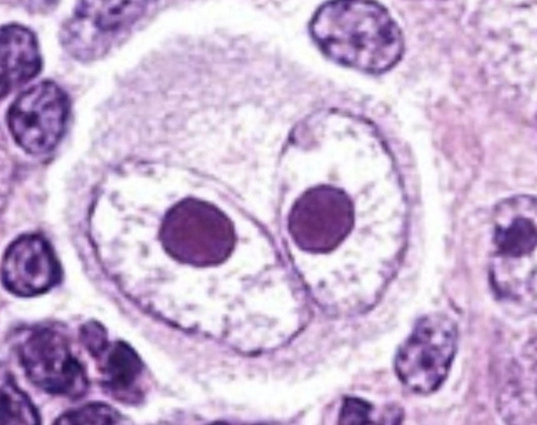 Pathology Images to Know for USMLE Step 1