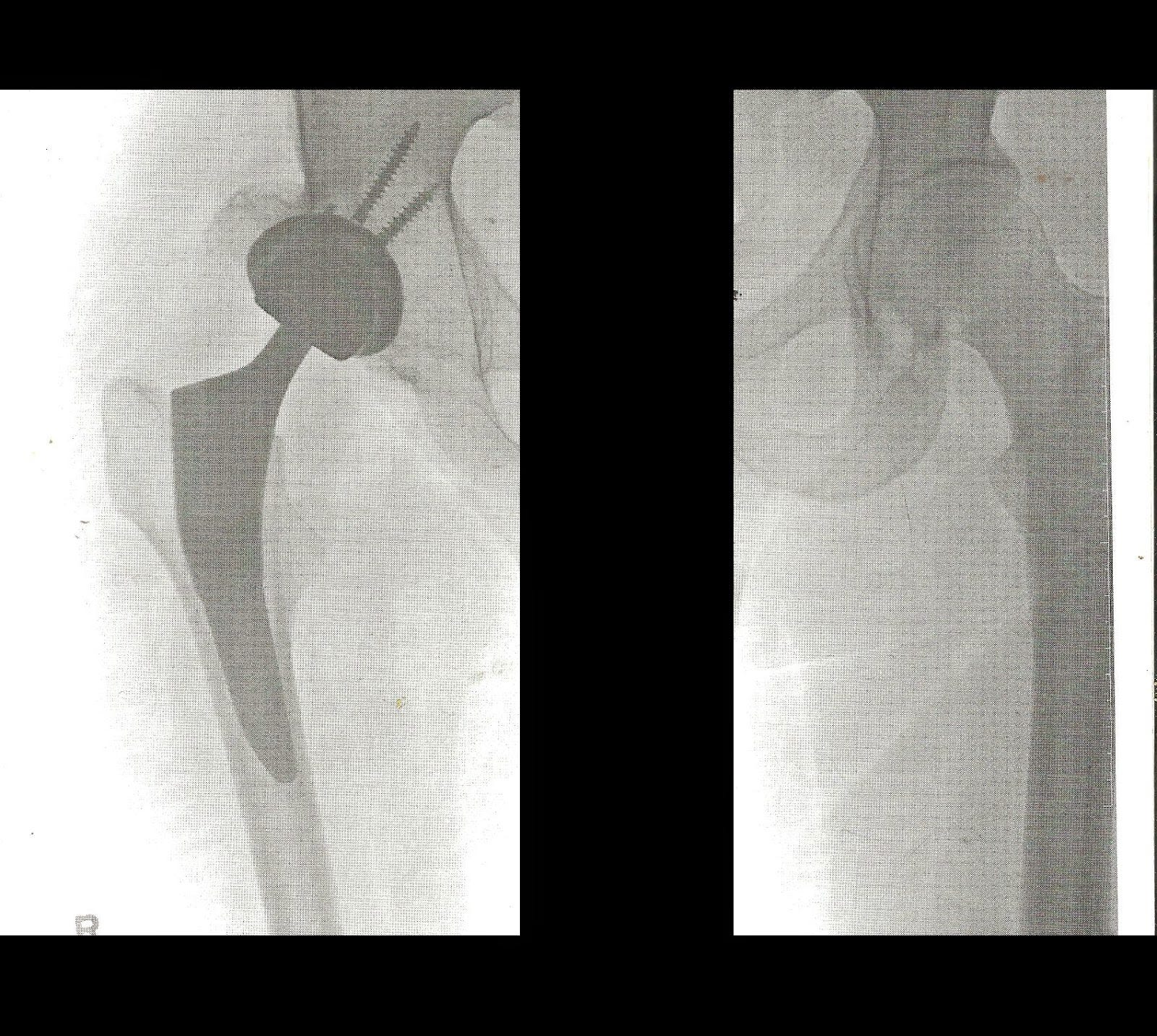 Update on Total Hip Replacement Surgery and Prayer Request