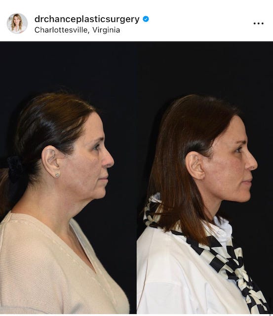The Insta-Famous Facelift - by Jolene Edgar