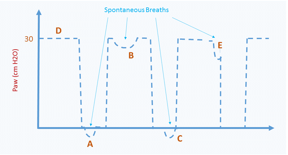 ICU Physiology in 1000 Words: Airway Pressure Release Ventilation – Part 2