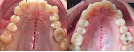 5.4 MARPE Surgical Assists - From Least to Most Invasive