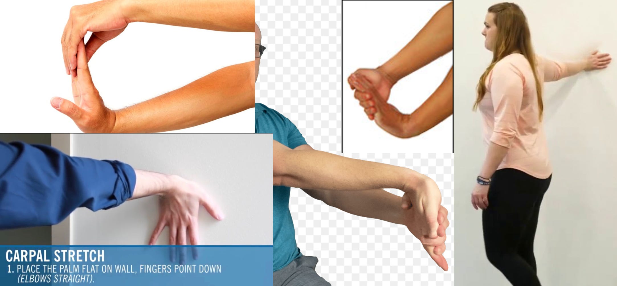 The Forgotten History of Carpal Tunnel Syndrome