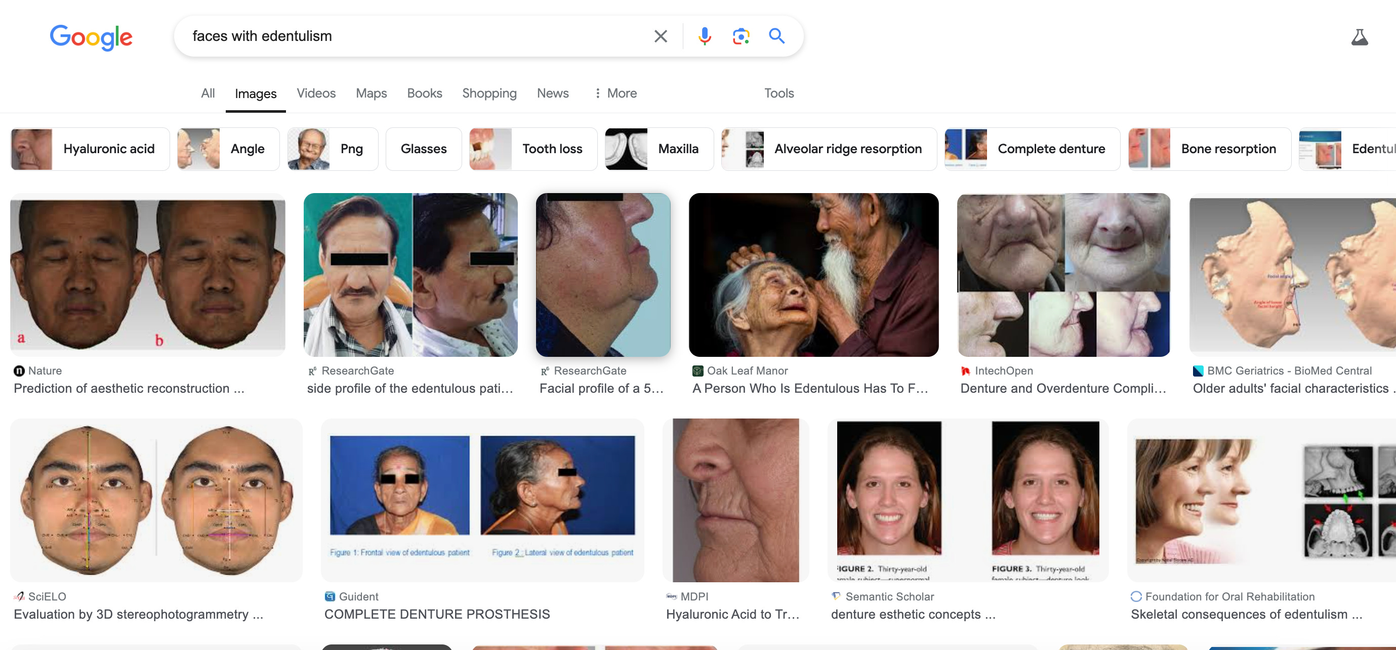 What can we learn from people without teeth (edentulism)?