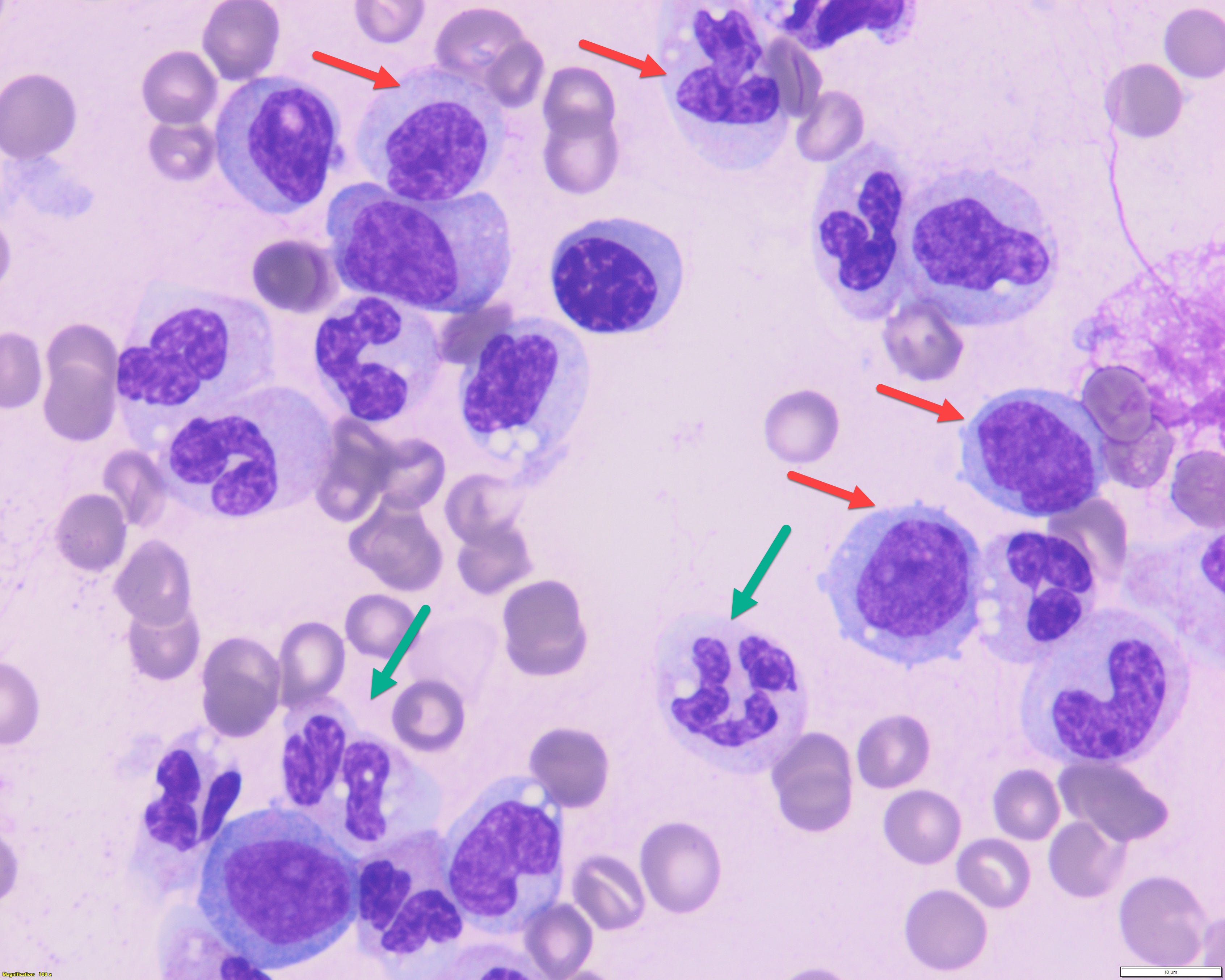 Metamyelocyte Vs Monocyte