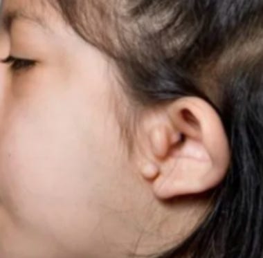 Pediatric Pearls: Infant's Ear - Pits, Tags, and the Pinna