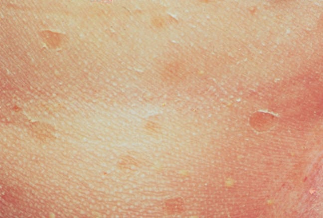 Pediatric Pearls: Infant's Skin Part 2 - My Big 4