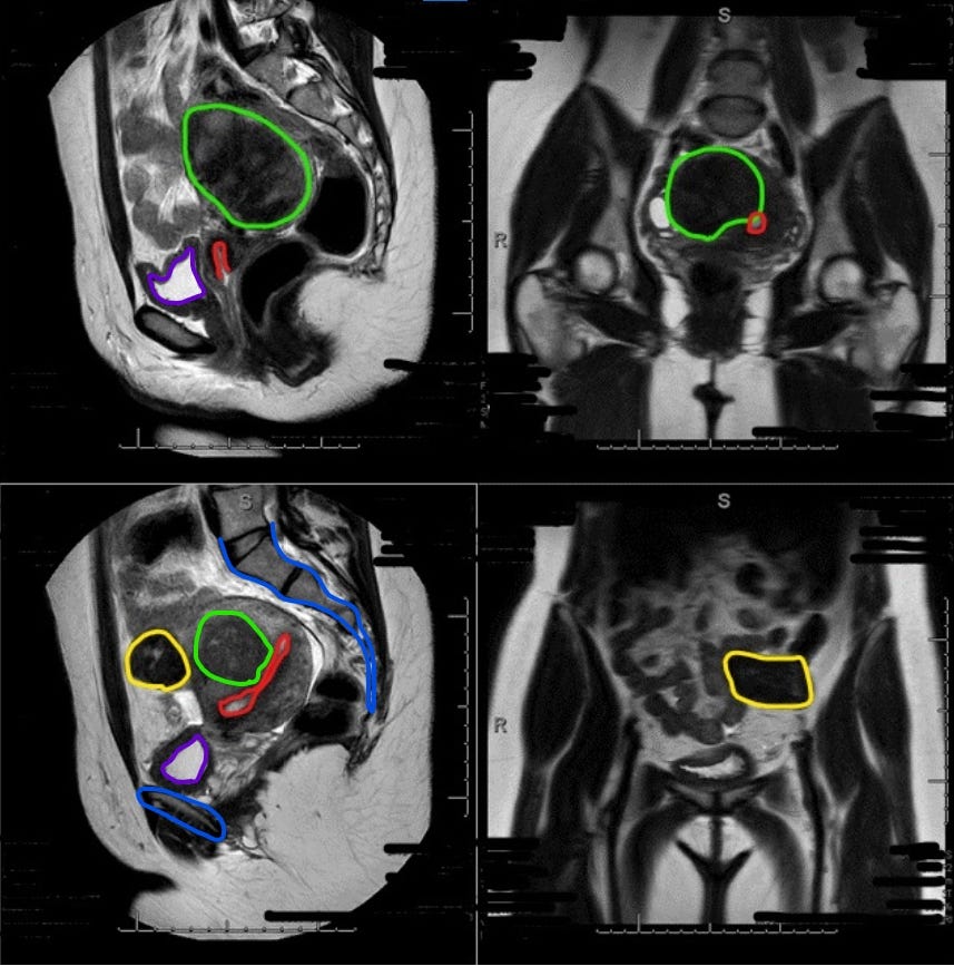 Three "cardinal sins" of fibroid uterus - by Dr. Huang
