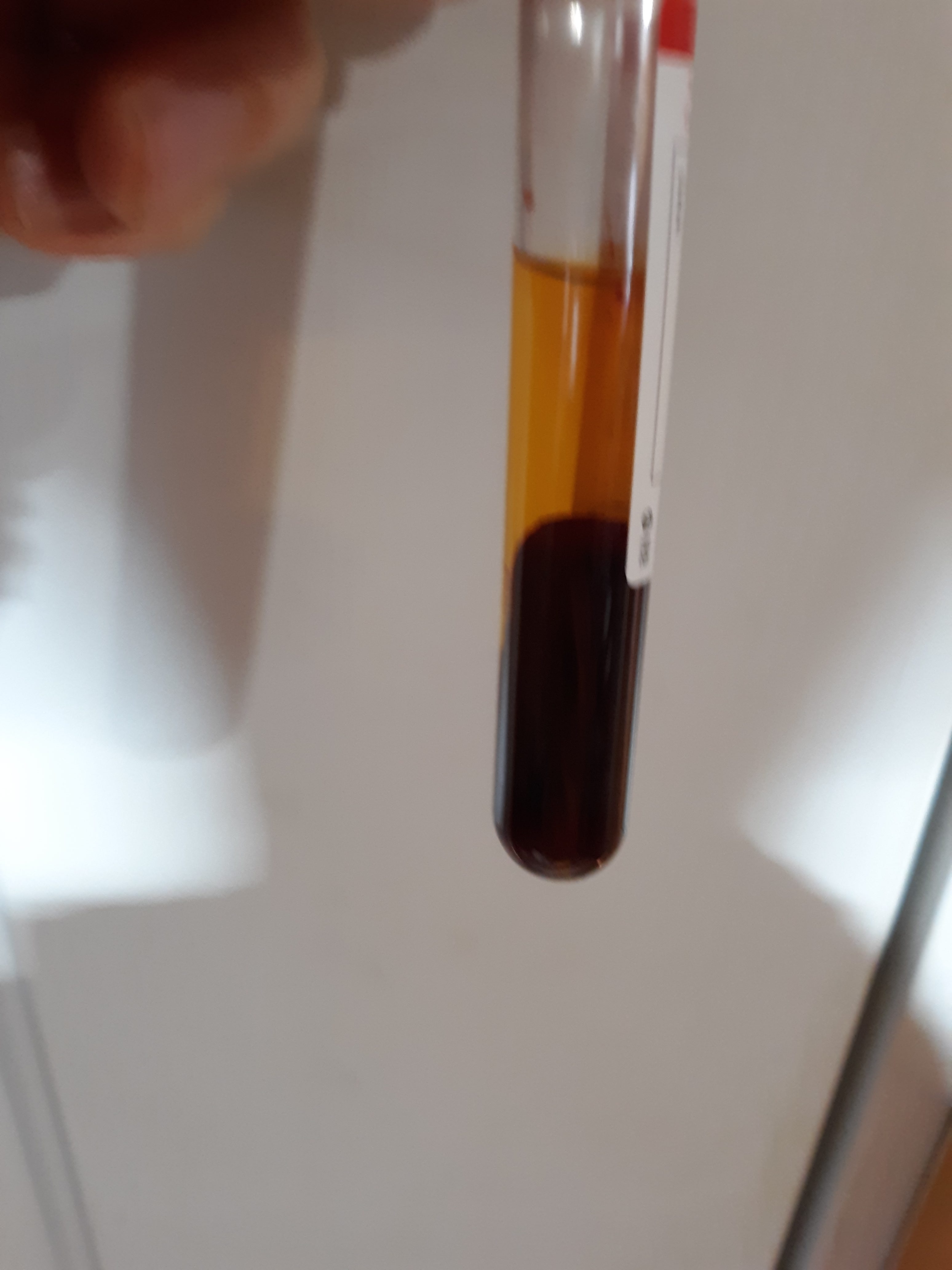 Remission Again, No Gel/Plastic, Rubber Clot in My Blood.