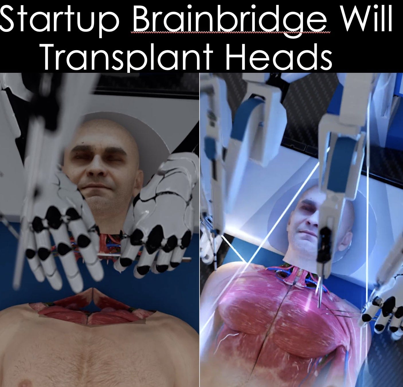 New Startup Brainbridge Wants to Perform Head Transplants