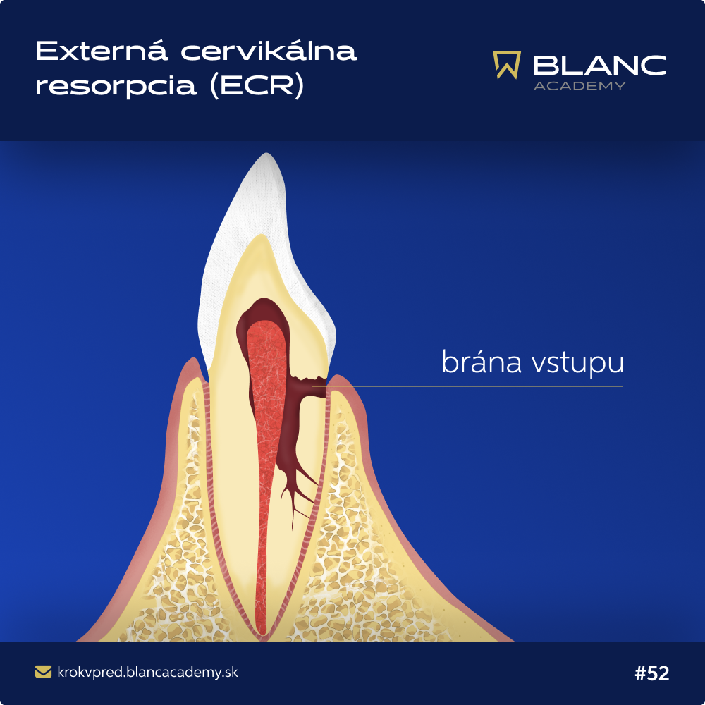#52 Externá cervikálna resorpcia (ECR)
