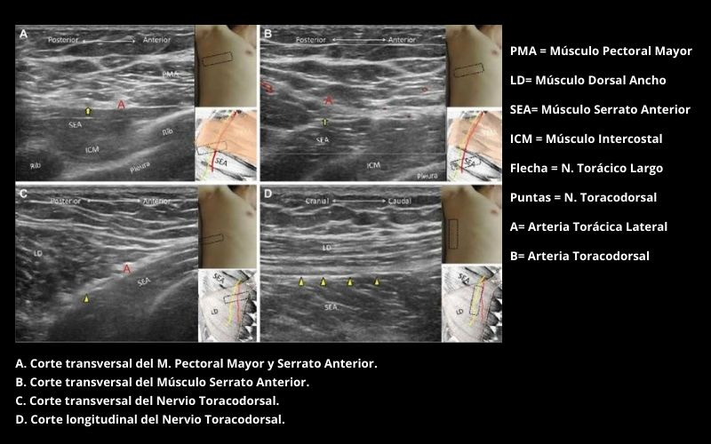 Nervio torácico largo y Nervio dorsal escapular