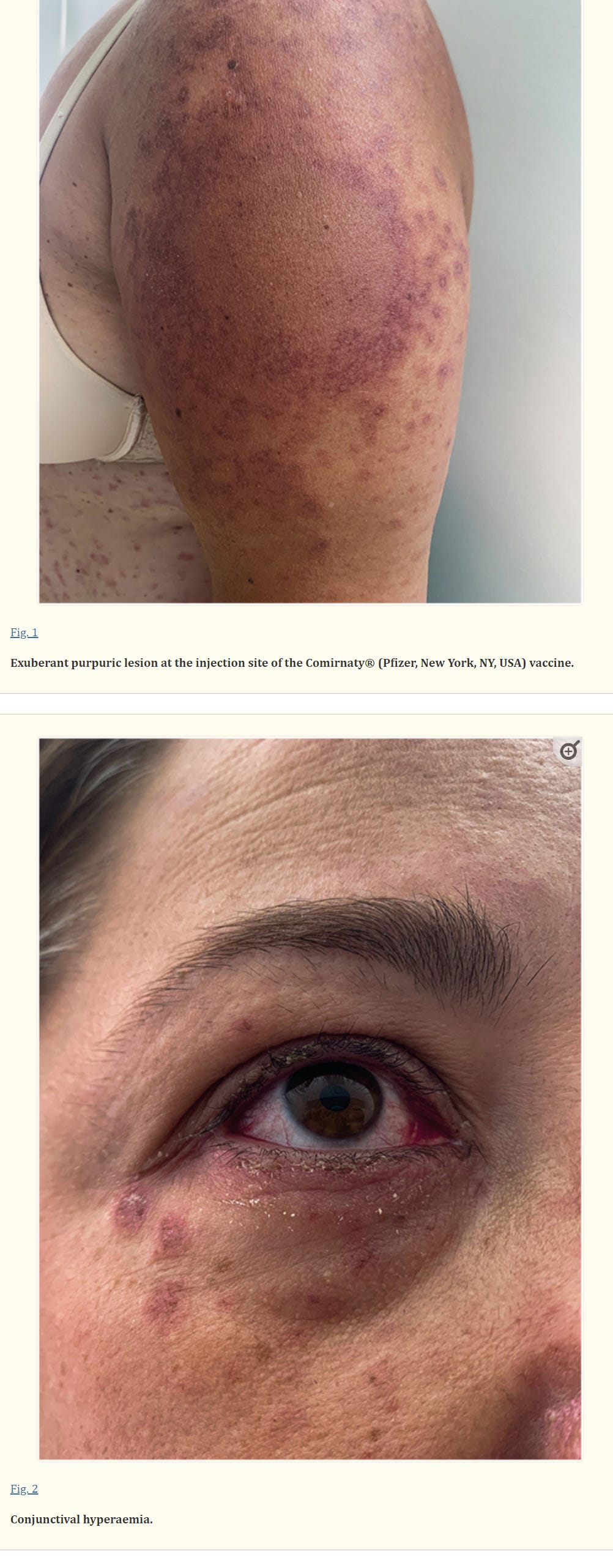 Cutaneous reactions to C-19 injections - by OUTRAGED HUMAN
