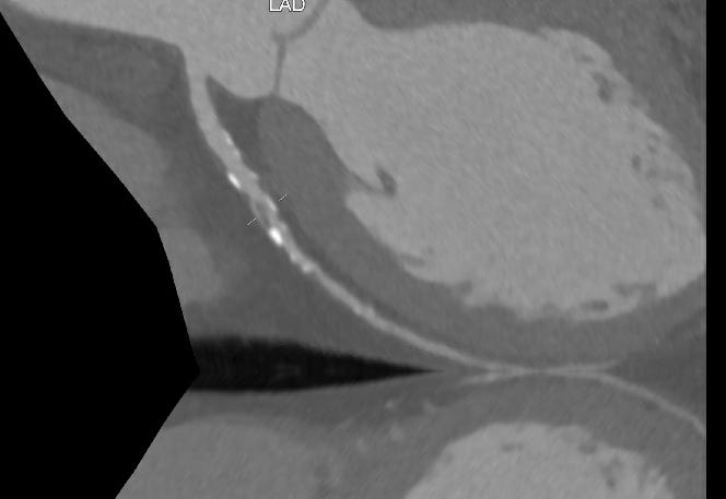 Coronary CT Angiography: Is it Time to View Your Coronary Arteries Cleerly?