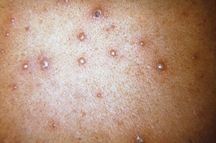 Penn State reports chickenpox outbreak - by Robert Herriman