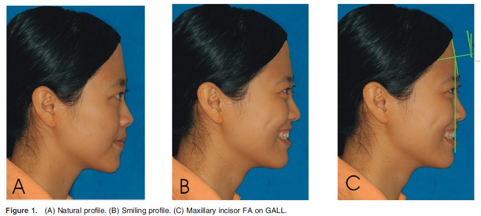 Effect of Maxillary Incisor Labiolingual Inclination and ...