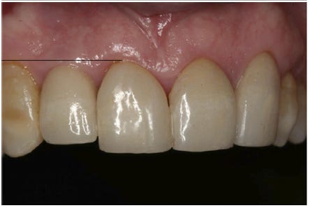 Continuous Tooth Eruption Adjacent to Single-Implant Restorations in ...