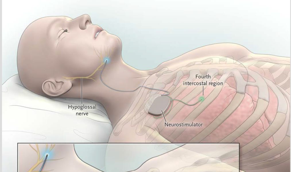 Inspire 2.0 - by Chris Gouveia, MD and Robson Capasso