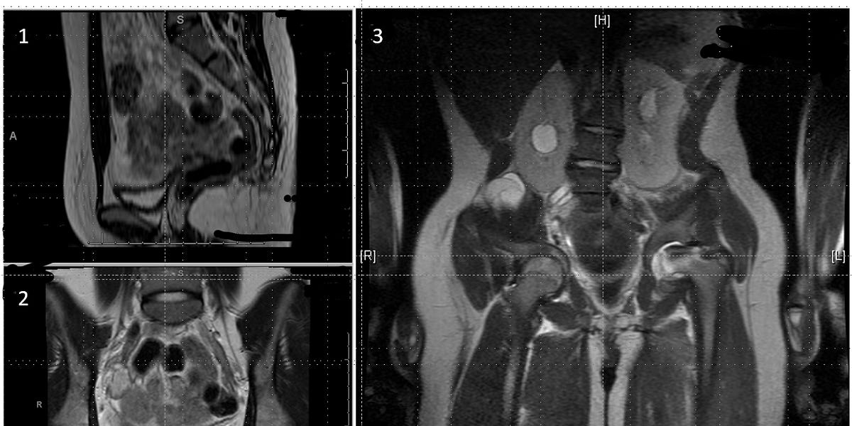 Mayer-Rokitansky-Küster-Hauser Syndrome: 3-step approach