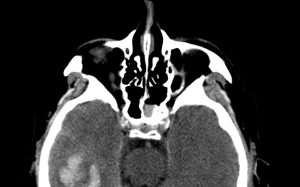 Cerebral contusion - by Alexander Baxter - RadNotes