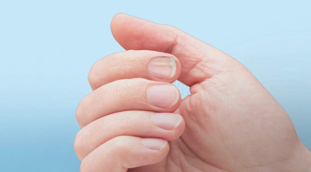 Fingernail Changes May Be Clues About Increased Cancer Risk