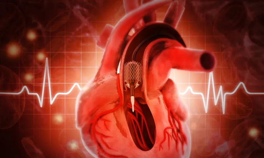 Os procedimentos de stent cardíaco funcionam para dor no peito angina?