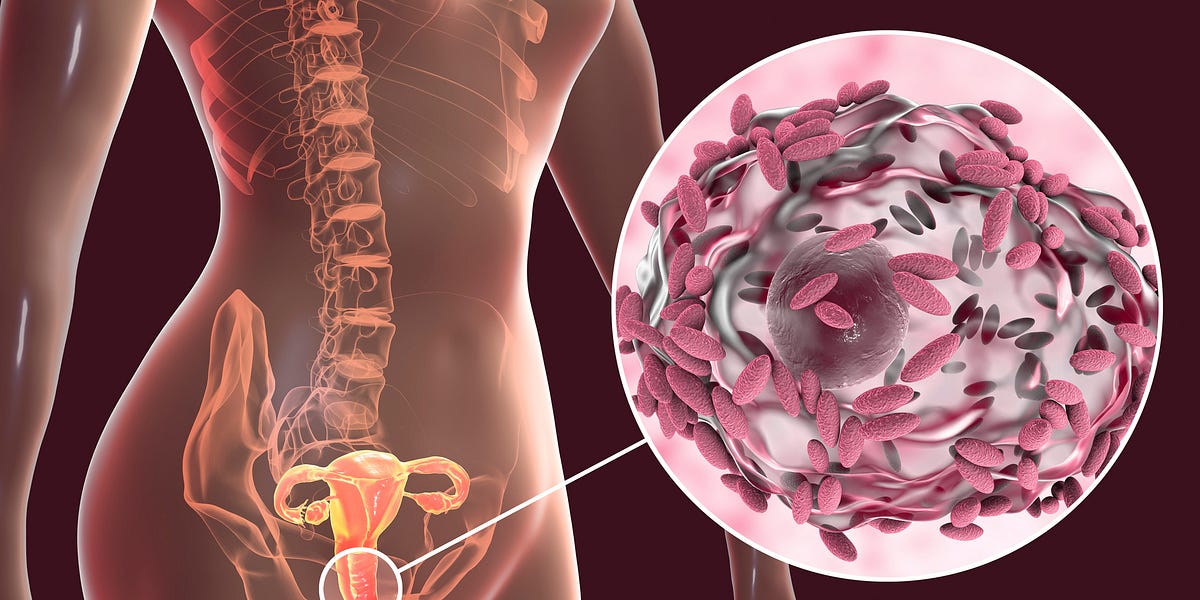 Desquamative Inflammatory Vaginitis - by Dr. Jen Gunter