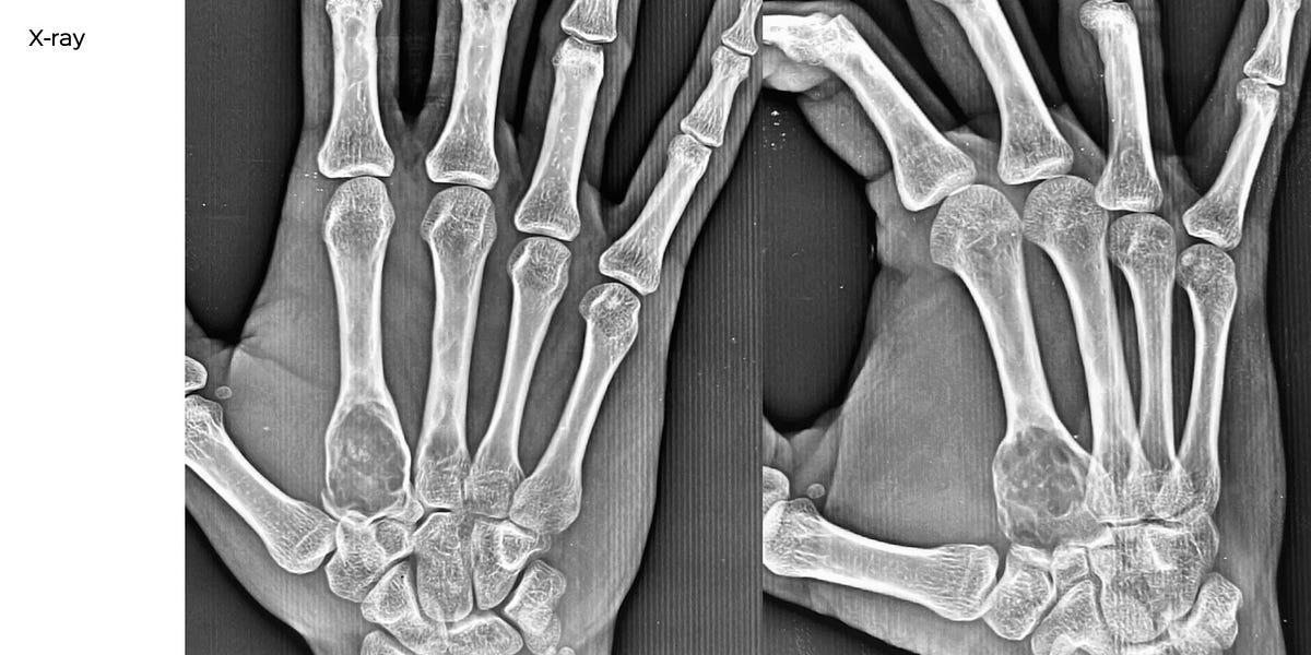 Case 26: A Dorsal Hand Swelling - by Bhavin Jankharia