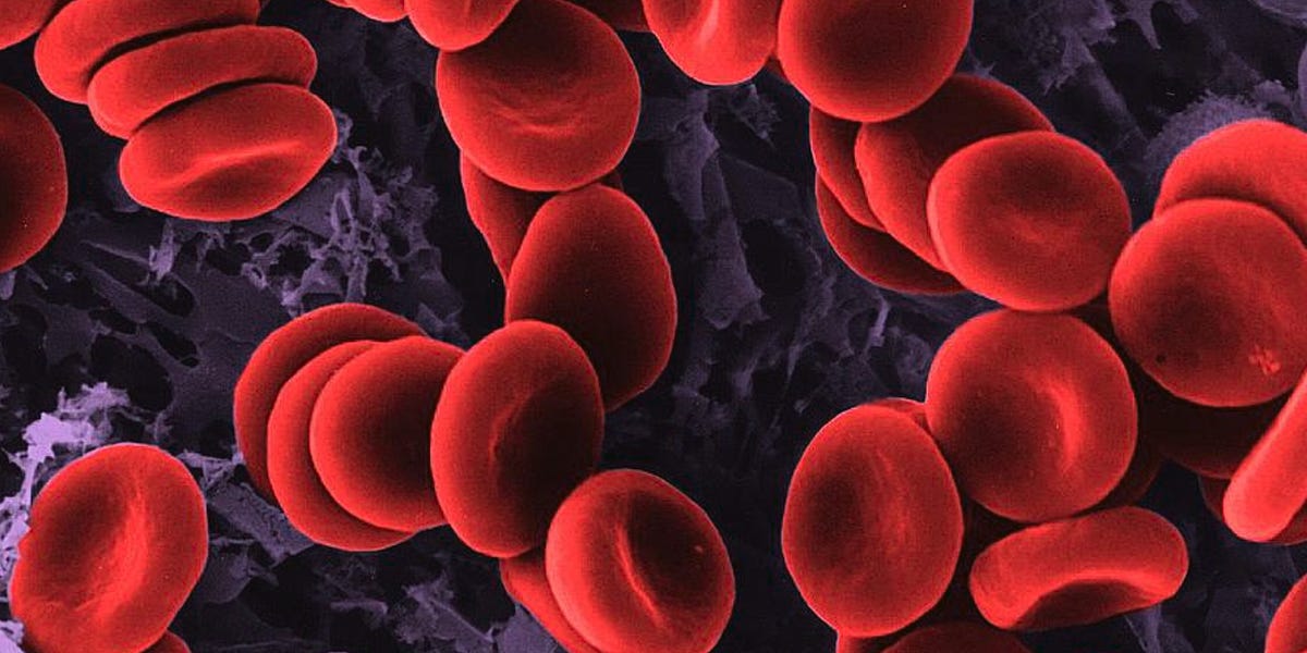 Is SARS-nCoV-2-associated systemic micro-clotting due to spike protein ...