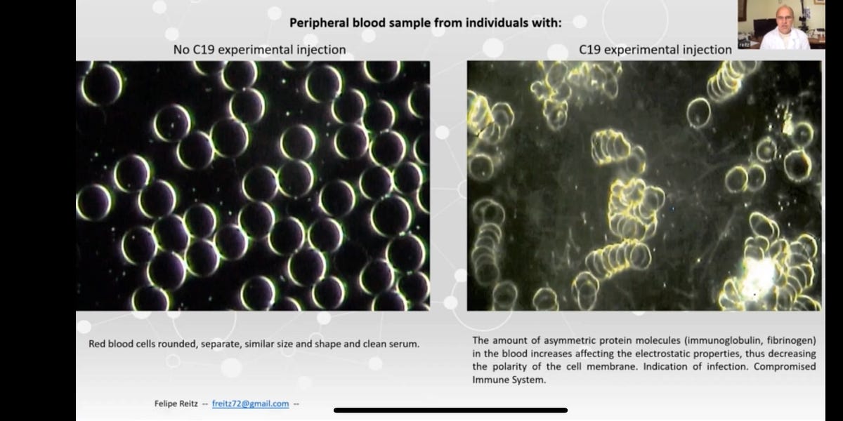 Computerized Thermographic Imaging and Live Blood Analysis Post C19 ...